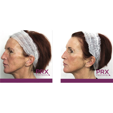 PRX-T33 Peel » Bella Medspa » Alpharetta & Buckhead