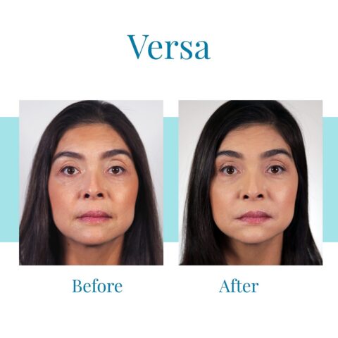 Best Versa Treatment in Buckhead and Alpharetta - Bella Medspa