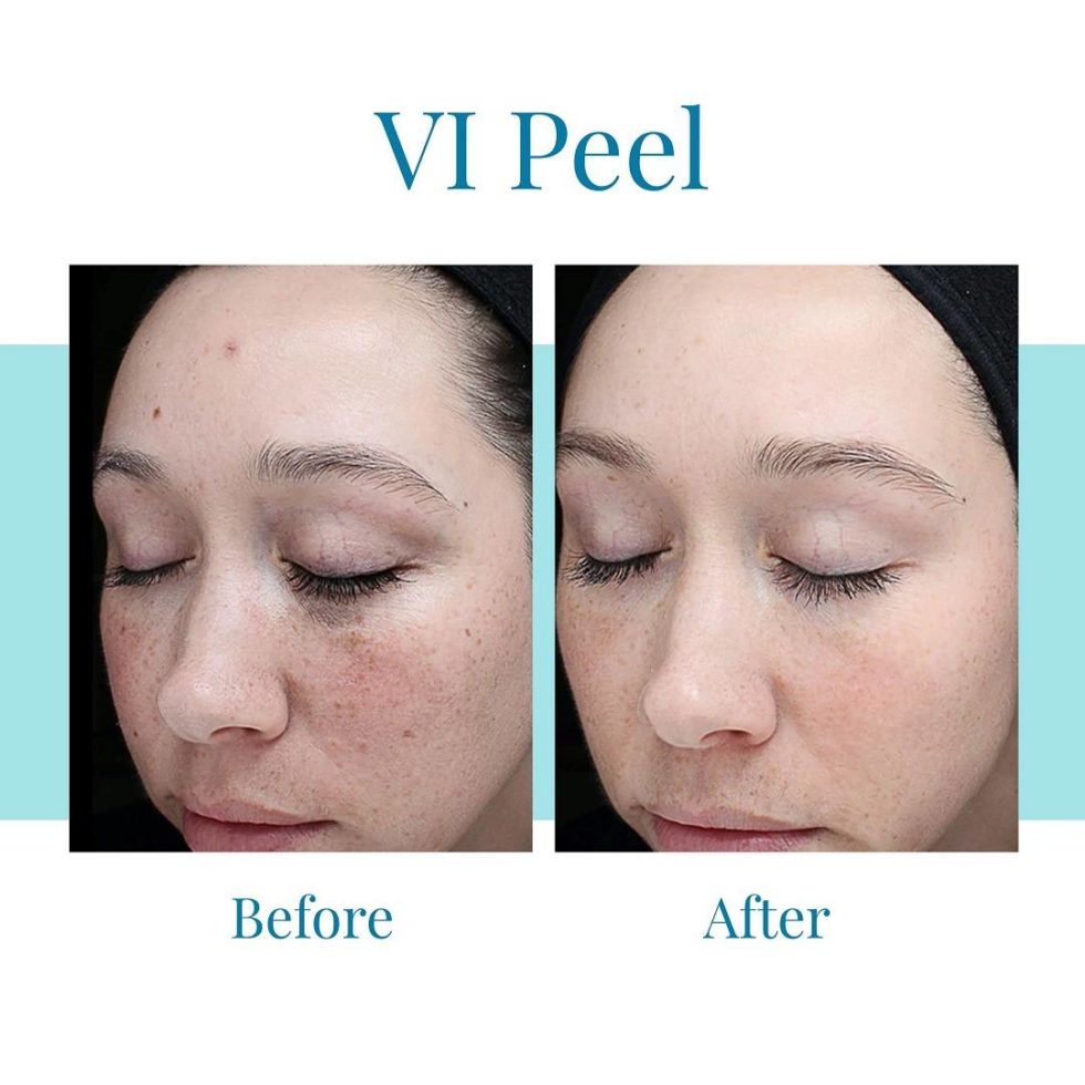 VI Peel Treatments » Bella Medspa » Buckhead & Alpharetta