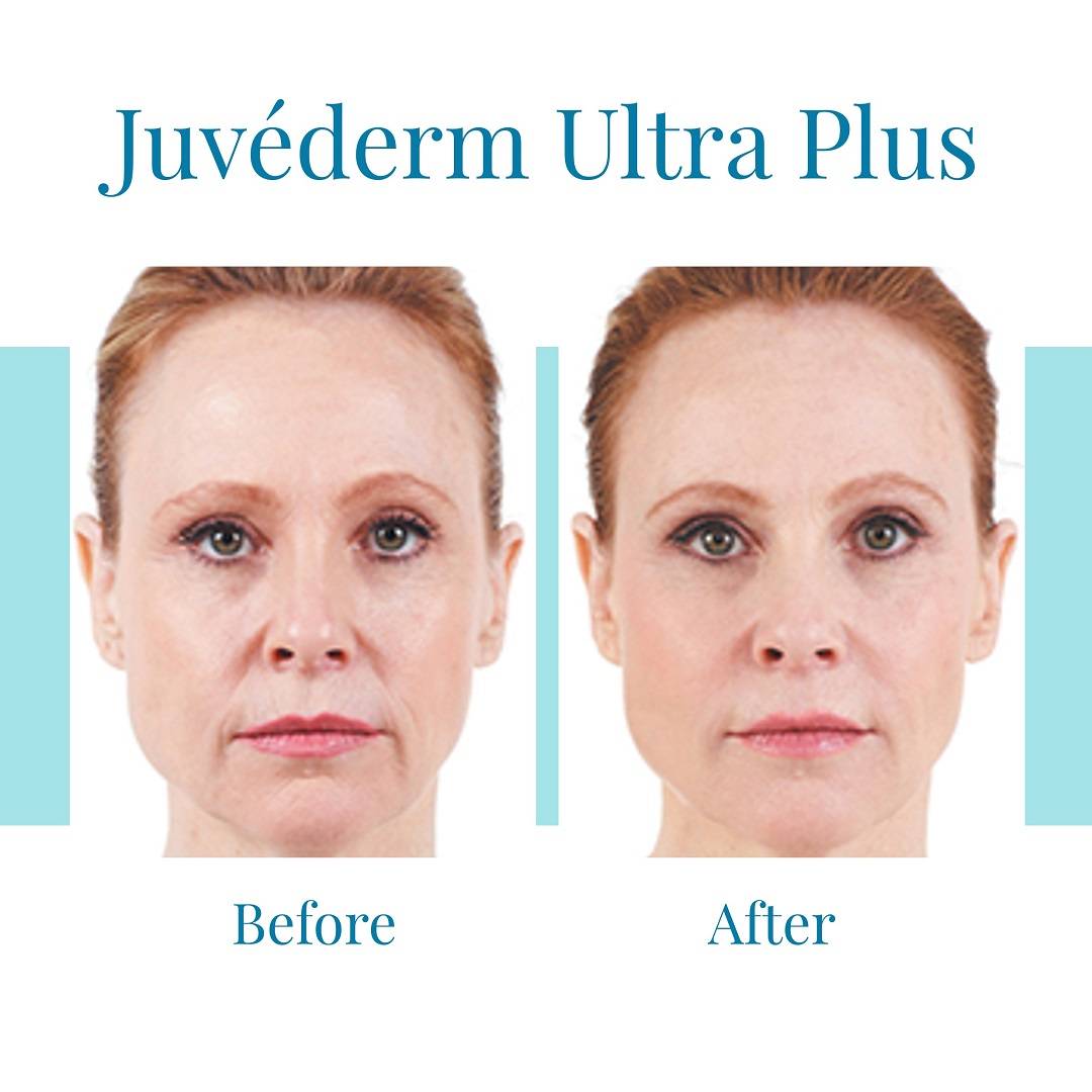 Best Juvéderm Ultra Plus Treatment in Buckhead and Alpharetta - Bella ...