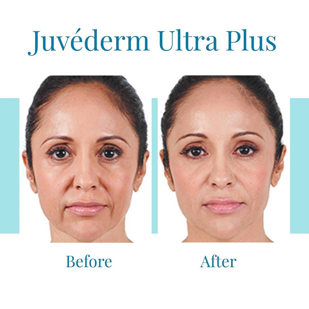 Best Juvéderm Ultra Plus Treatment in Buckhead and Alpharetta - Bella ...