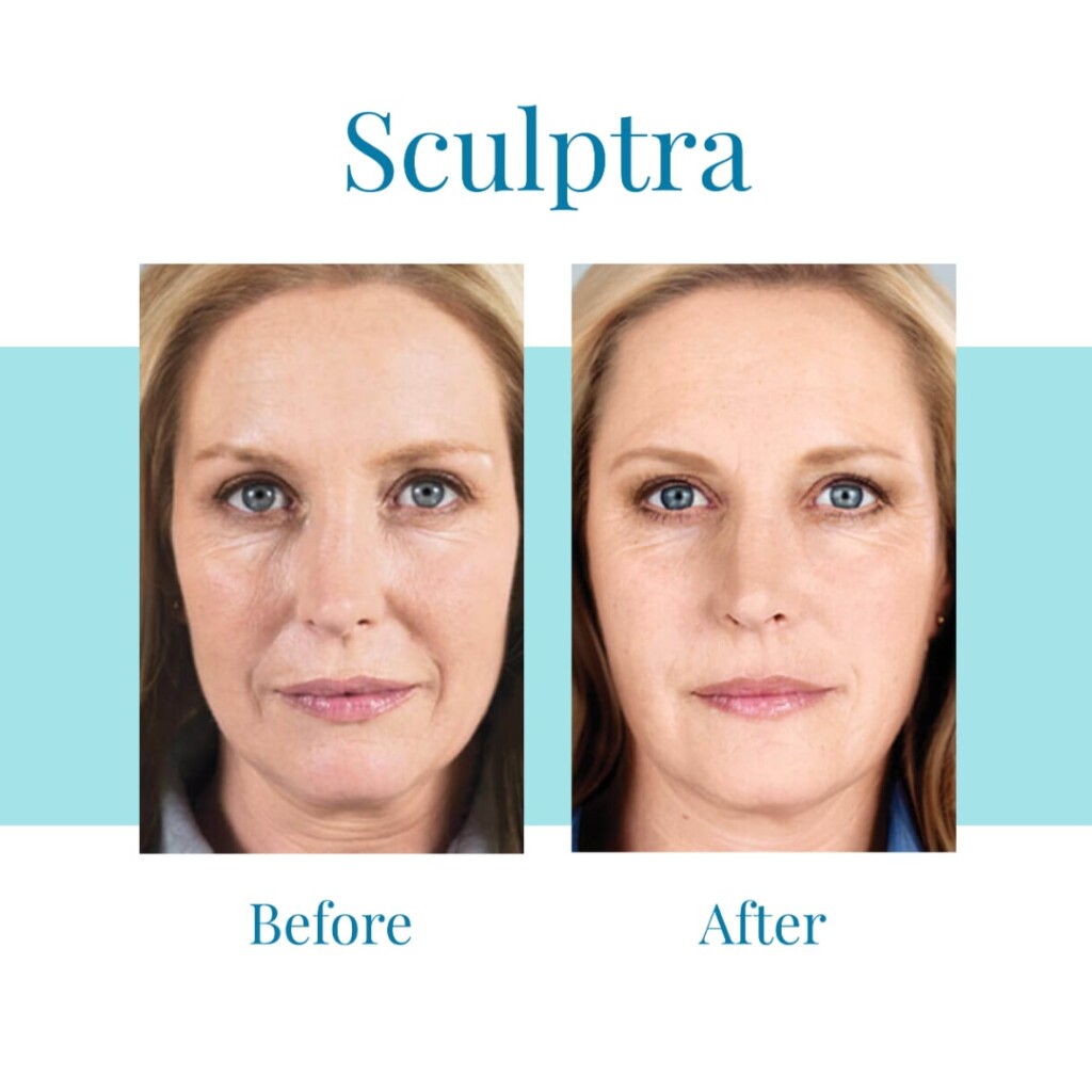 Best Sculptra Injections » Bella Medspa » Buckhead & Alpharetta