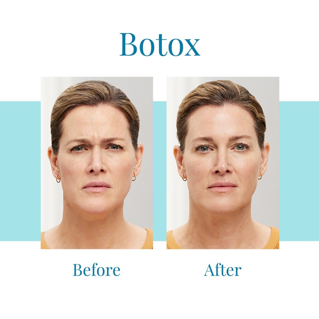 Best Botox Injections » Bella Medspa » Buckhead & Alpharetta